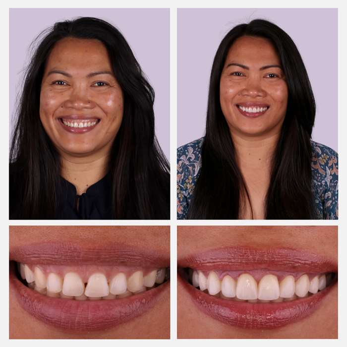 Smile Gallery | Paradise Dental